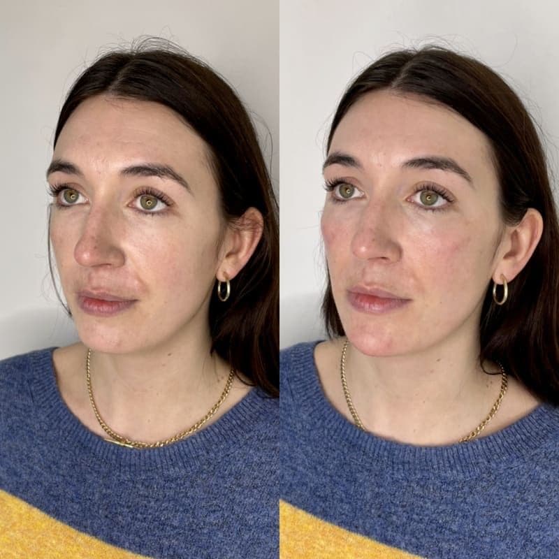 Before and Afters | Dermal Fillers & Botox Belfast | Dr Amy Aesthetics