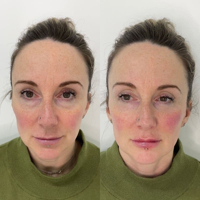 Before and Afters | Dermal Fillers & Botox Belfast | Dr Amy Aesthetics